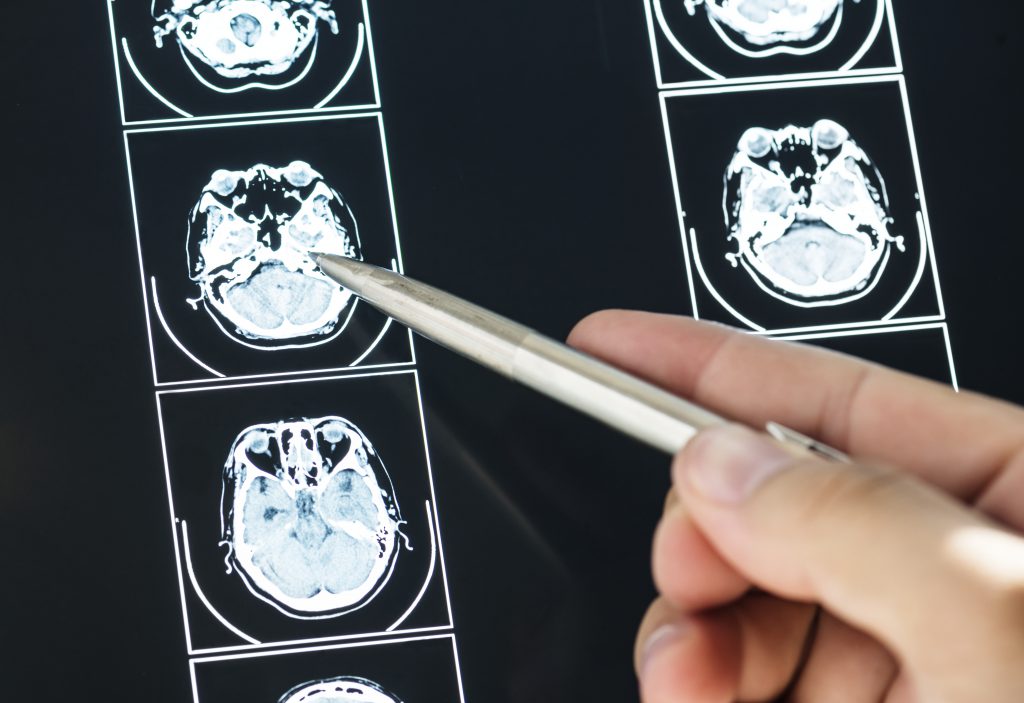 MRI and ALS Diagnosis | AffordableMRI.com