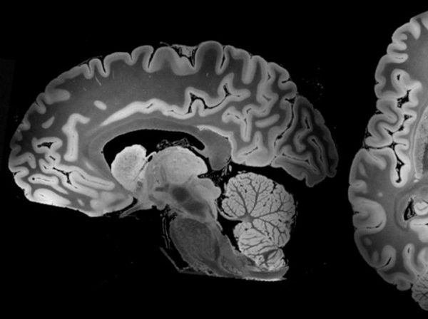 MRI scan the most detailed look at a whole human brain | AffordableMRI.com